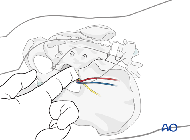 Posterior approach to the SI joint