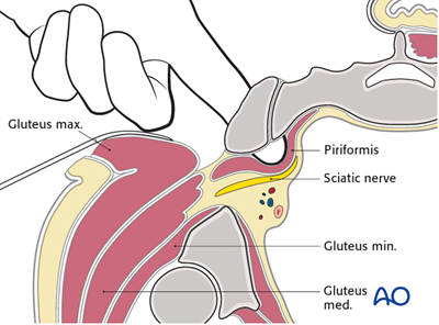 Posterior approach to the SI joint