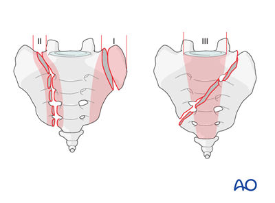 Posterior approach to the sacrum