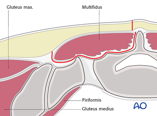 Posterior approach to the sacrum