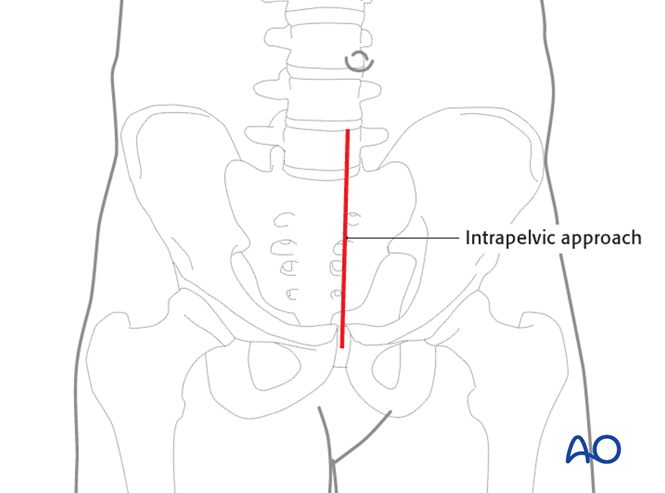Modified stoppa to the anterior intrapelvic region