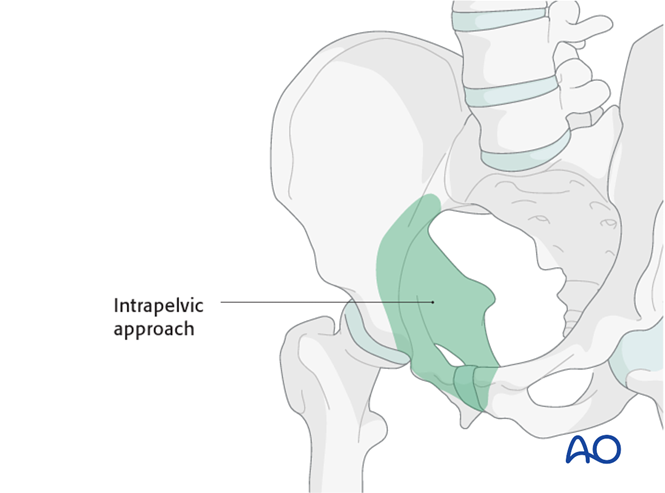 Modified stoppa to the anterior intrapelvic region
