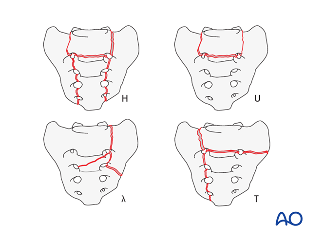 Sacral fractures