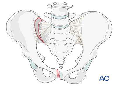 SI-joint fractures