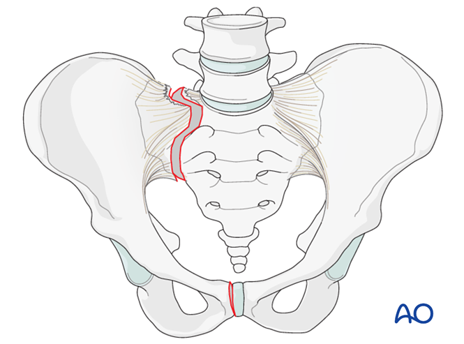 SI-joint fractures
