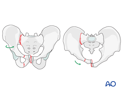 Pubic symphysis fractures