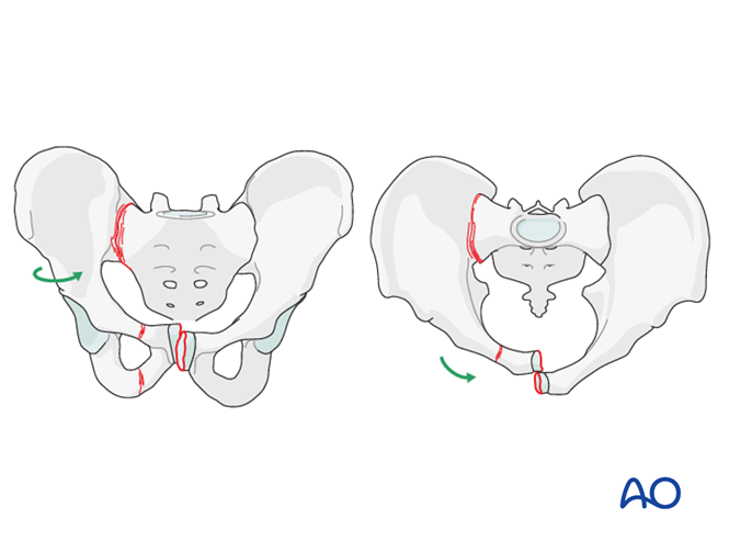 Pubic symphysis fractures
