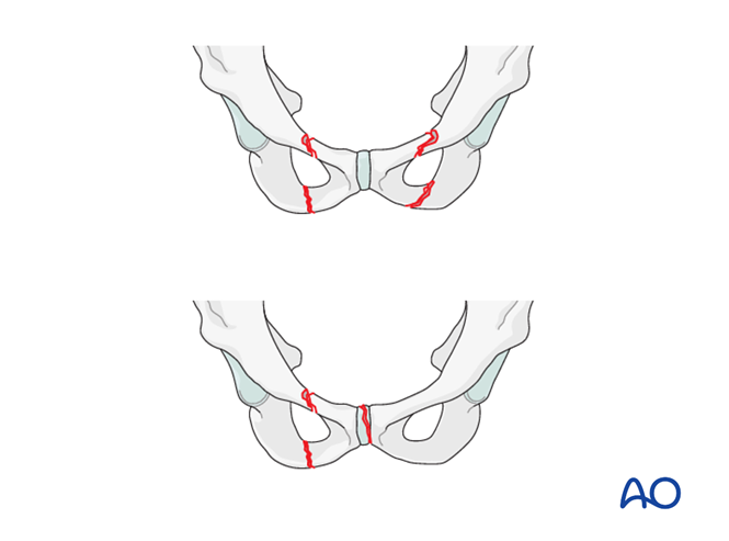 Incomplete disruption of posterior arch, bilateral injury