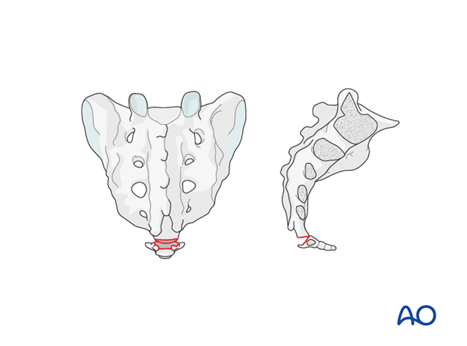 Intact posterior arch, sacrococcygeal dislocation