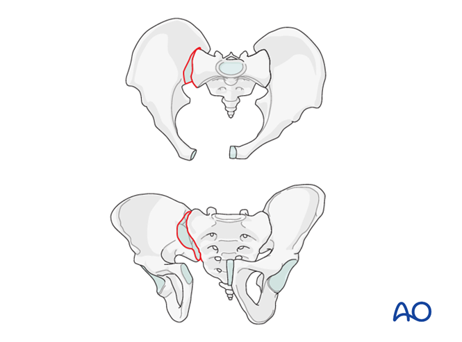 Incomplete disruption of posterior arch, open book injury