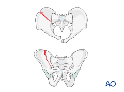 Operative treatment for Incomplete disruption of posterior arch ...