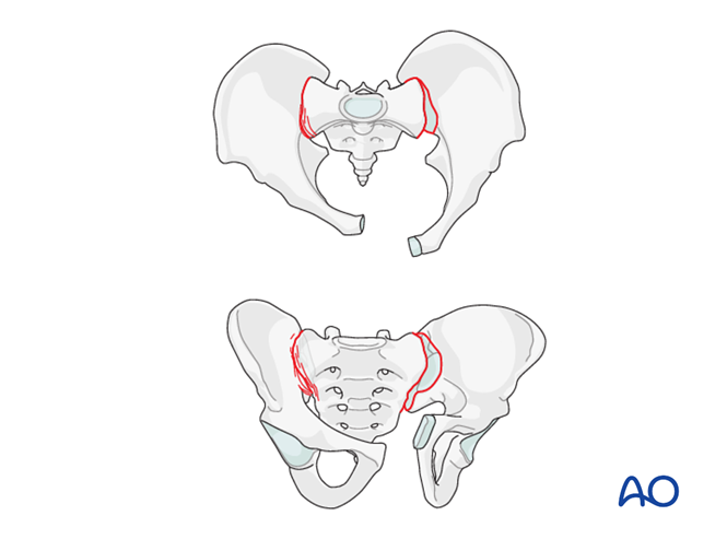 Incomplete disruption of posterior arch, bilateral injury