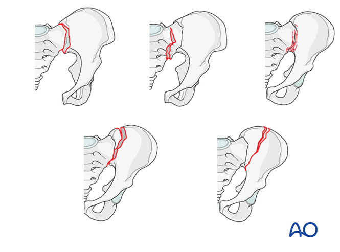 Unilateral complete, contralateral incomplete disruption of posterior arch