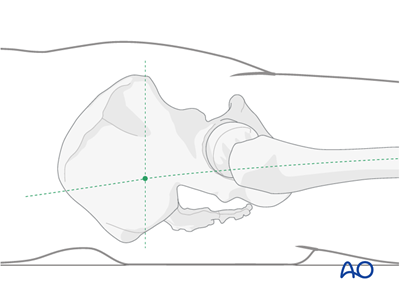 External fixation: Emergency stabilization with a C-clamp for Acute ...