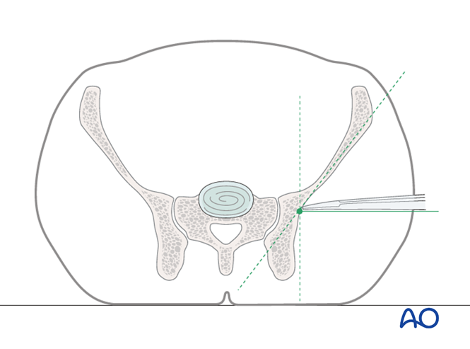 External fixation: Emergency stabilization with a C-clamp for Acute ...