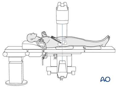 External fixation: Emergency stabilization with a C-clamp for Acute ...