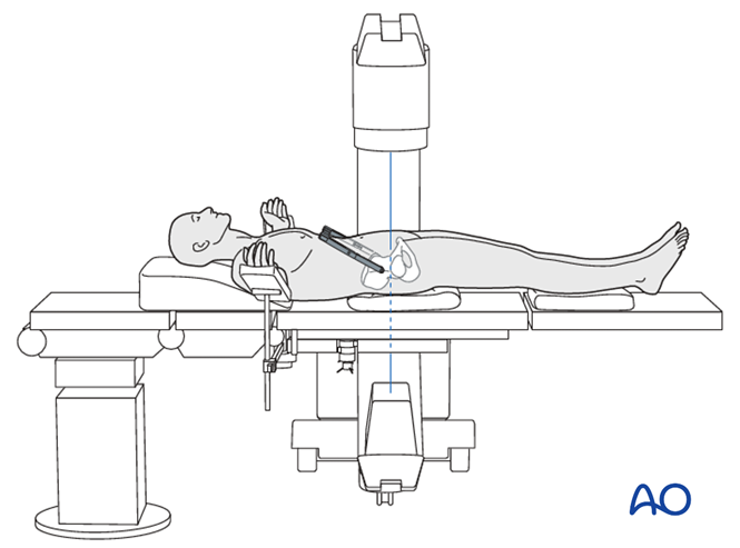 External fixation: Emergency stabilization with a C-clamp for Acute ...