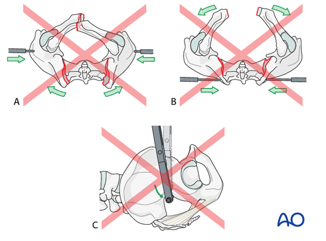 External fixation: Emergency stabilization with a C-clamp for Acute ...