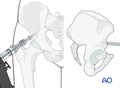 External fixation