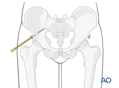External fixation for Acute pelvic treatment