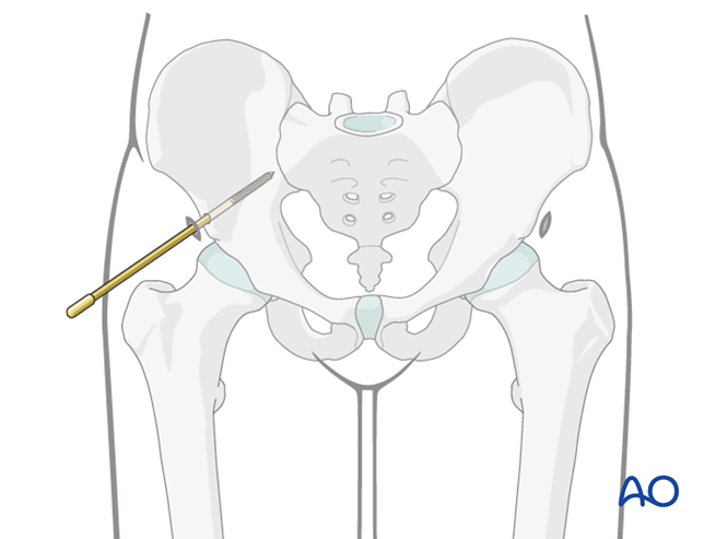 External fixation for Acute pelvic treatment
