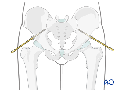 External fixation for Acute pelvic treatment