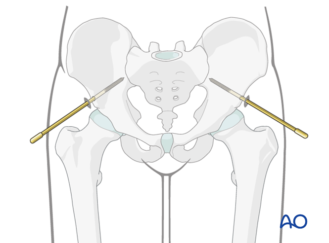 External fixation for Acute pelvic treatment