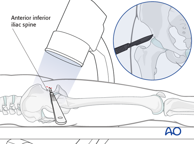 External fixation for Acute pelvic treatment
