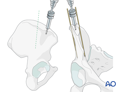 External fixation for Acute pelvic treatment