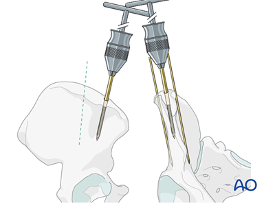 External fixation for Acute pelvic treatment