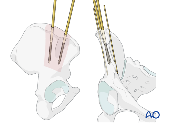 External fixation for Acute pelvic treatment