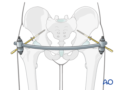 External fixation