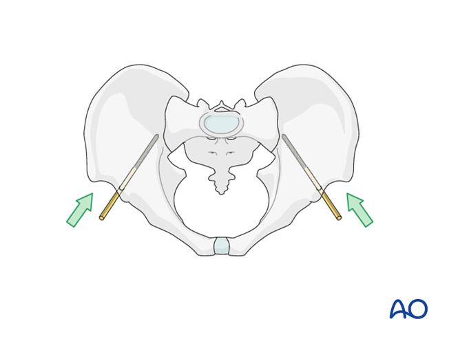 External fixation for Acute pelvic treatment