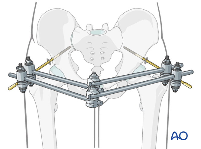 External fixation for Acute pelvic treatment