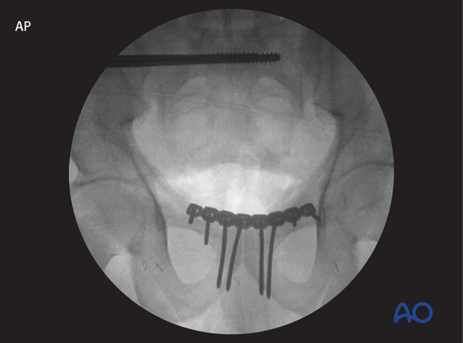 ORIF - Pubic symphysis plate for Pubic symphysis fractures