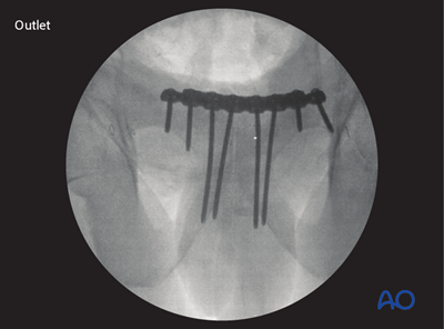 ORIF - Pubic symphysis plate for Pubic symphysis fractures
