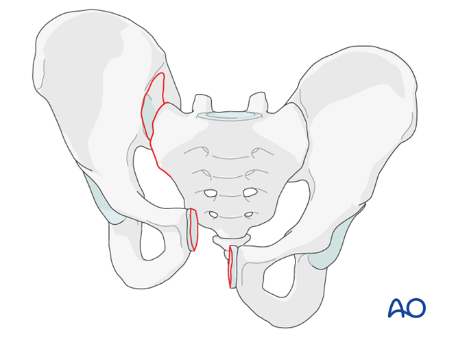 ORIF - Pubic symphysis plate for Pubic symphysis fractures