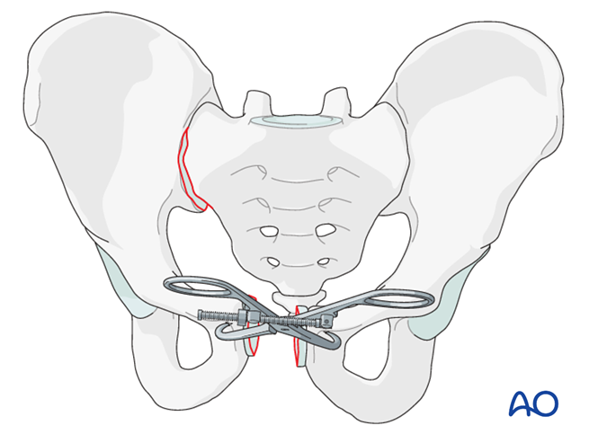 ORIF - Pubic symphysis plate for Pubic symphysis fractures