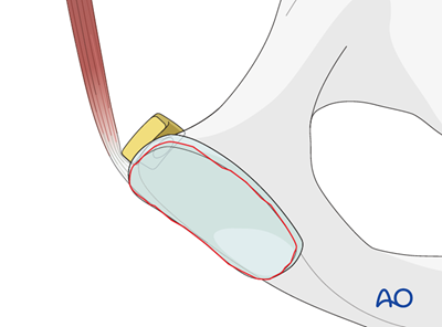ORIF - Pubic symphysis plate for Pubic symphysis fractures