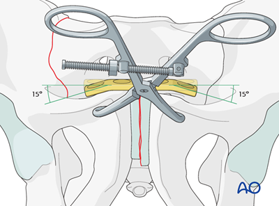 ORIF - Pubic symphysis plate for Pubic symphysis fractures