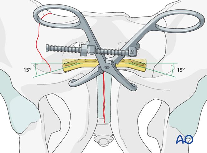 Pubic symphysis plate