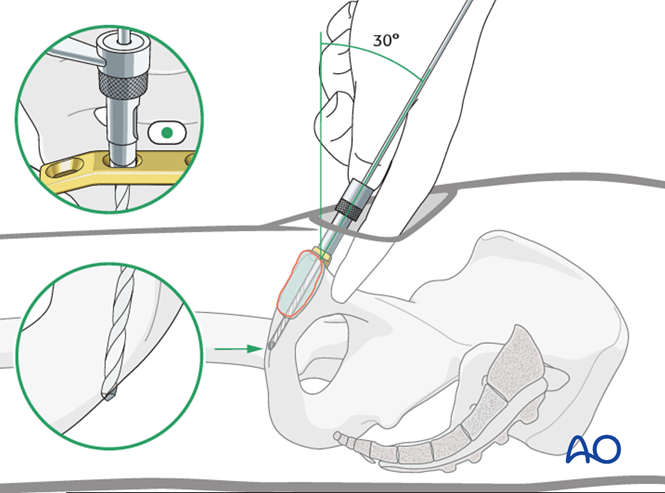 ORIF - Pubic symphysis plate for Pubic symphysis fractures