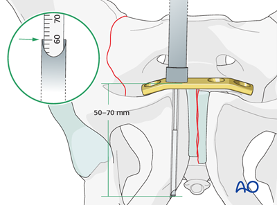 Pubic symphysis plate