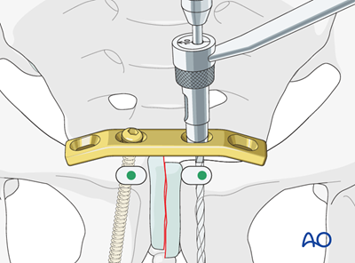 ORIF - Pubic symphysis plate for Pubic symphysis fractures