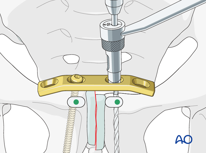 Pubic symphysis plate