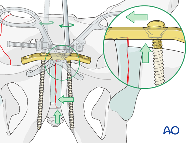 Pubic symphysis plate
