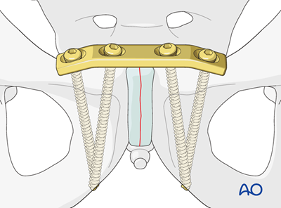 Operative treatment for Incomplete disruption of posterior arch, open ...