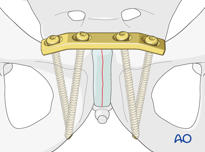 ORIF - Pubic symphysis plate for Pubic symphysis fractures