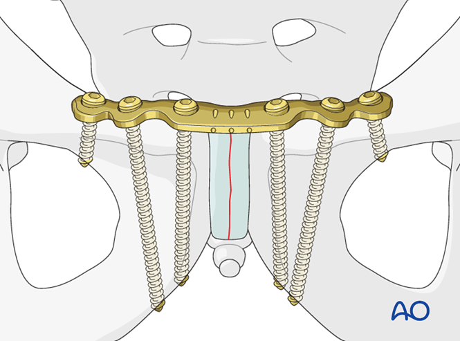 ORIF - Pubic symphysis plate for Pubic symphysis fractures
