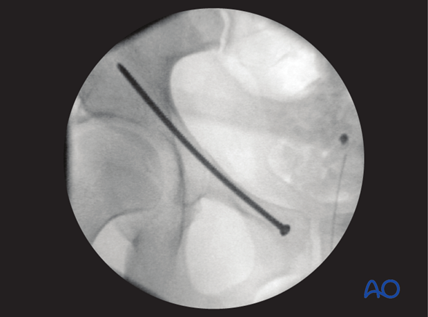 Orif Pubic Ramus Screw For Pubic Ramus Fractures